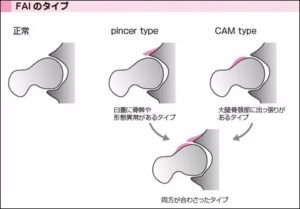 股関節の詰まり感はFAIが原因？FAIの症状、評価、リハビリ【理学療法】 | リハビリの一助となりますように