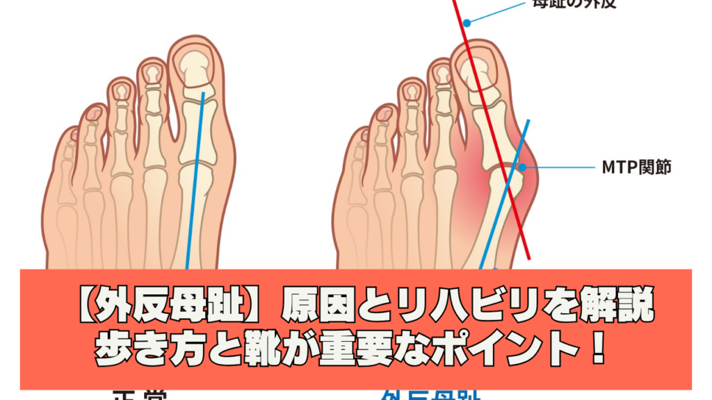 【外反母趾】歩き方と靴が重要なポイント！原因とリハビリを解説 | リハビリの一助となりますように
