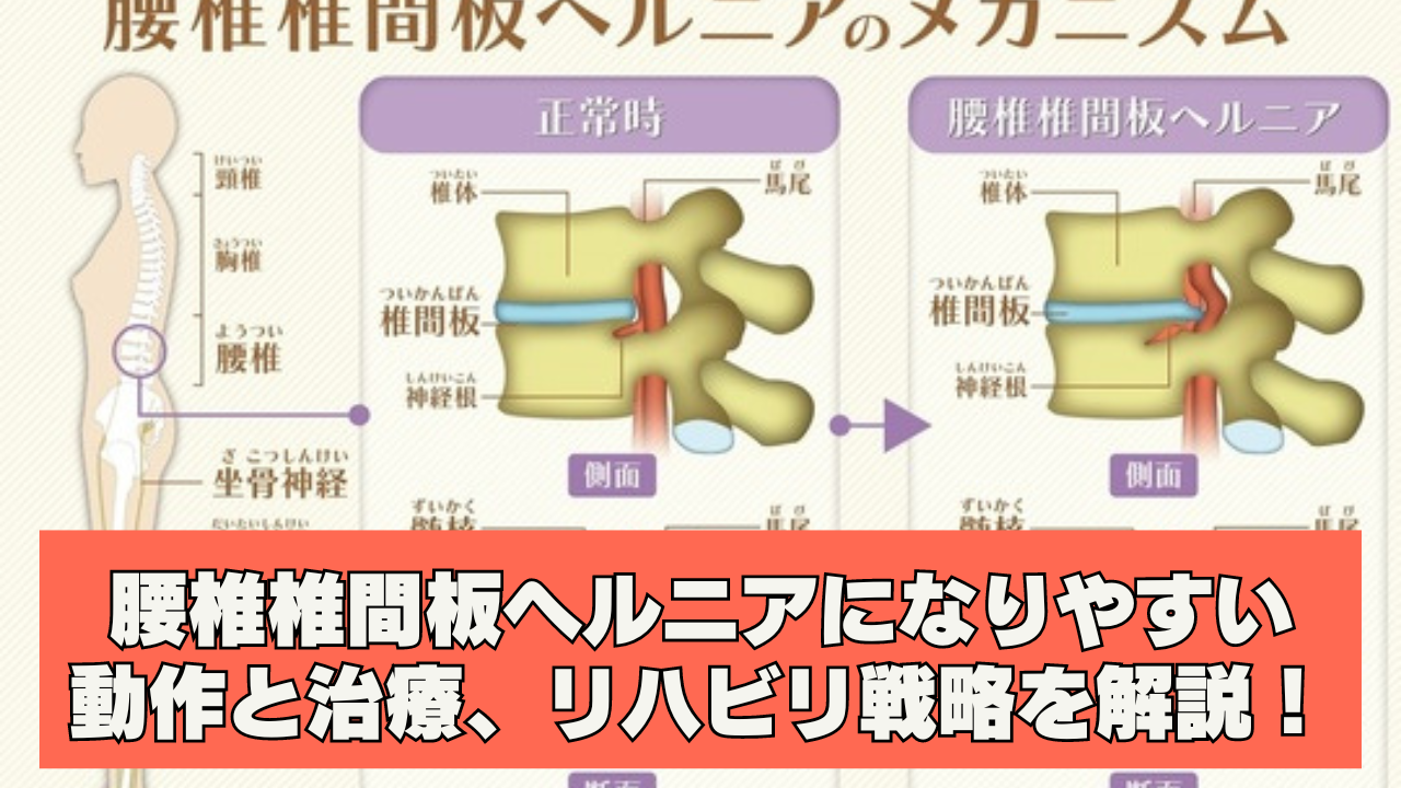【腰椎椎間板ヘルニア】なりやすい動作と治療、リハビリ戦略を解説！ | リハビリの一助となりますように