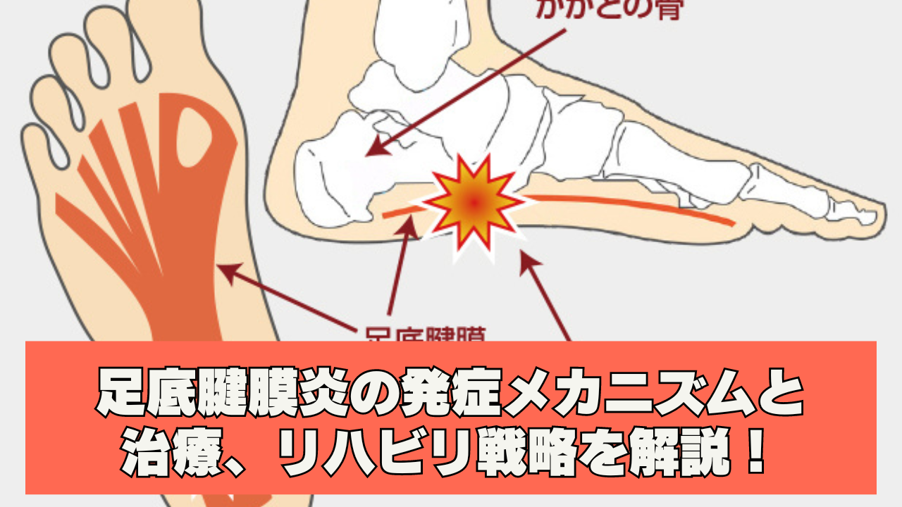 【足底腱膜炎】発症メカニズムと治療、リハビリ戦略を解説！ | リハビリの一助となりますように
