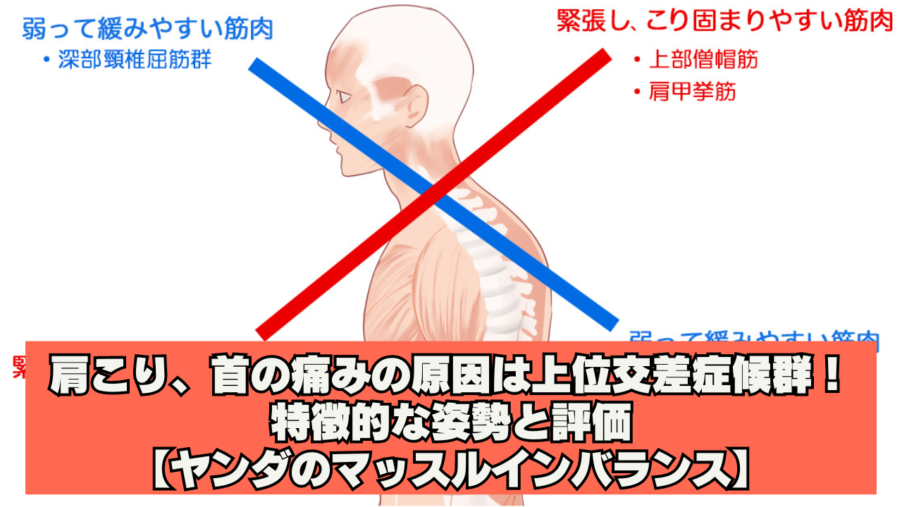 肩こり、首の痛みの原因は上位交差症候群！特徴的な姿勢と評価【ヤンダのマッスルインバランス】 | リハビリの一助となりますように