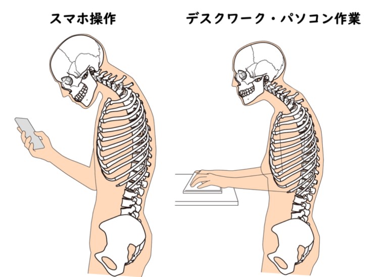 肩こり、首の痛みの原因は上位交差症候群！特徴的な姿勢と評価【ヤンダのマッスルインバランス】 | リハビリの一助となりますように